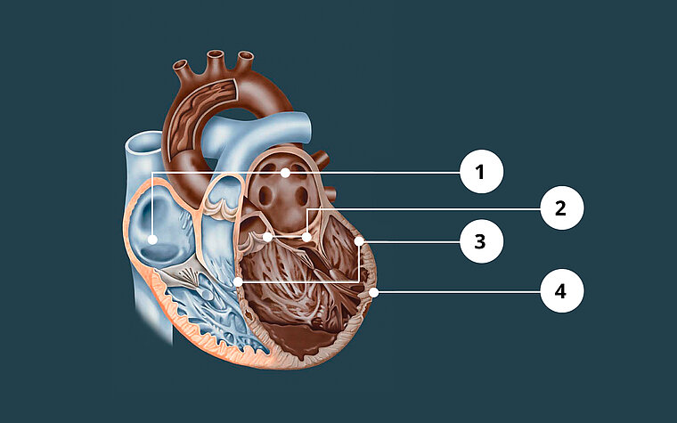 Behandlung von Herzinsuffizienz in der Bochumer Kardiologie ...